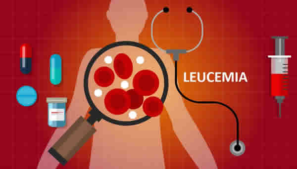 Leucemia: exames de rotina podem confirmar diagnóstico e garantir ...